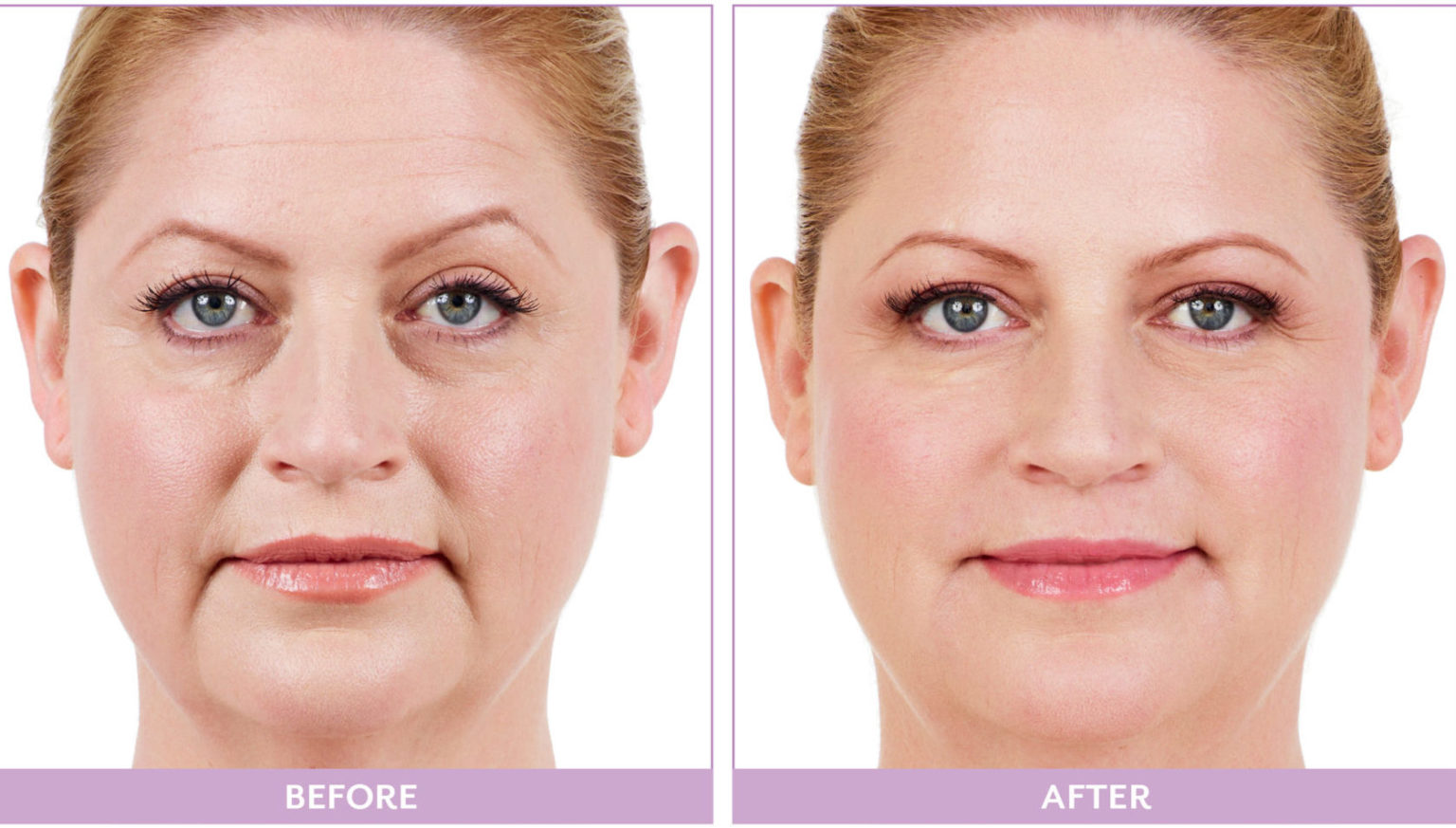 Botox vs Fillers: Which is right for you? | Red Mountain Weight Loss