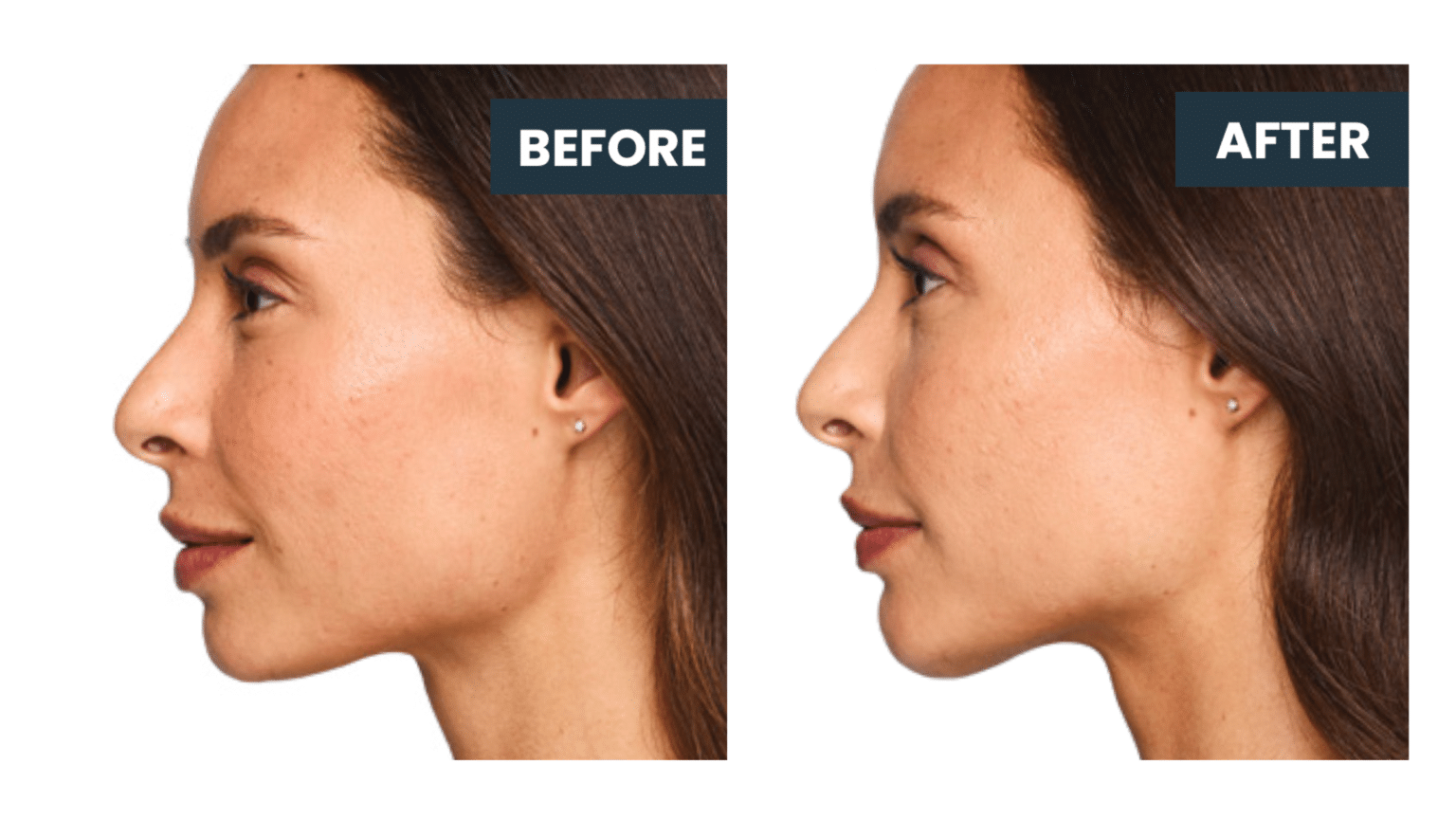 Meet Juvéderm Volux XC: The Newest Jawline Filler | Red Mountain Weight ...